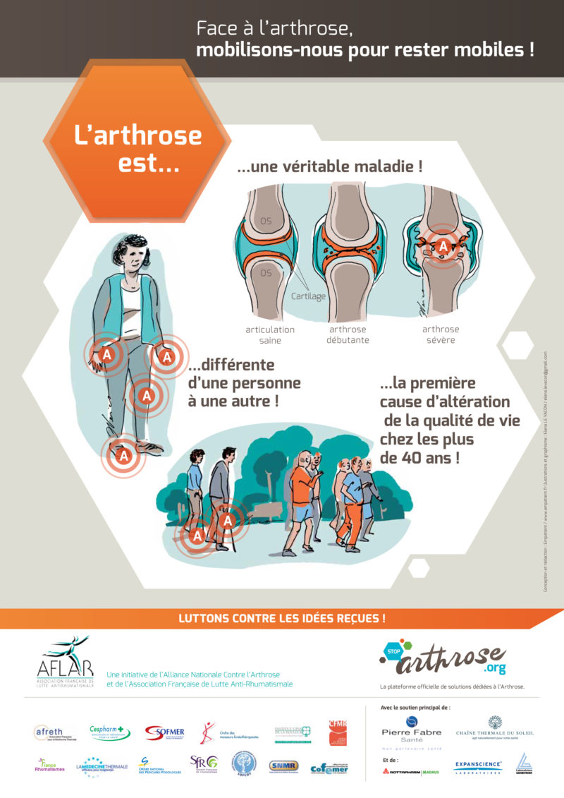 L'arthrose, une véritable maladie de l'articulation